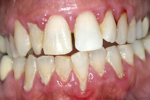 Parodontologie et prévention - Dr Pierre Galindo